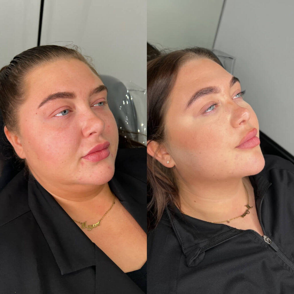 Fat Dissolving Injection in Islamabad | Fat Dissolving Treatment