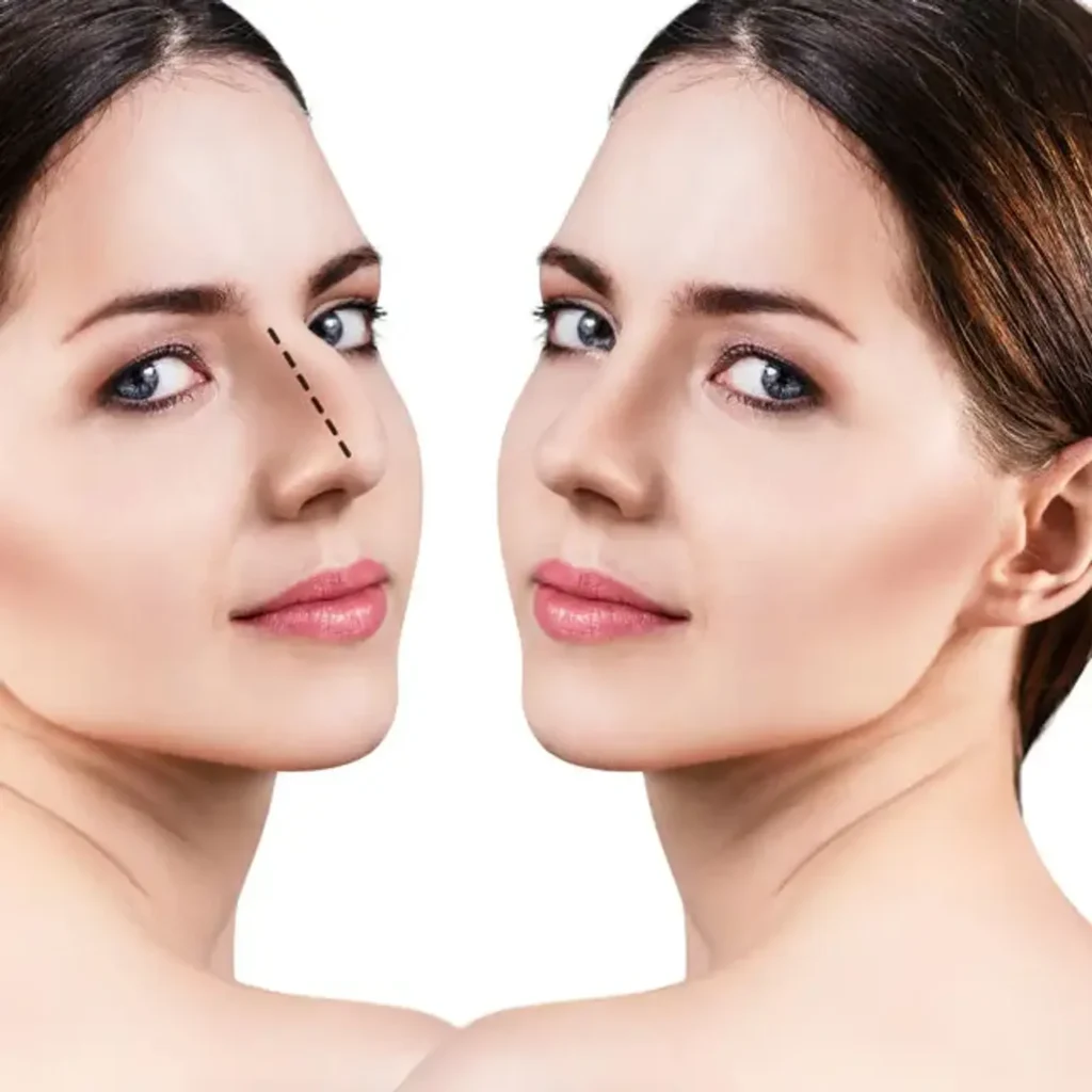 Nose Reshaping in Islamabad | Book Now for Expert Care